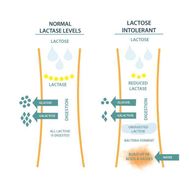 A Guide to Diagnosing and Managing Lactose Intolerance